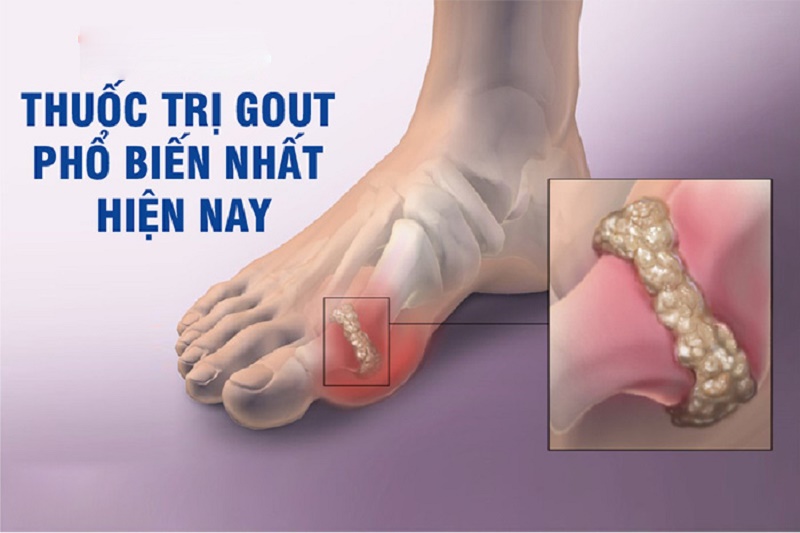 Bị Gút nên uống thuốc gì hiệu quả nhanh nhất?